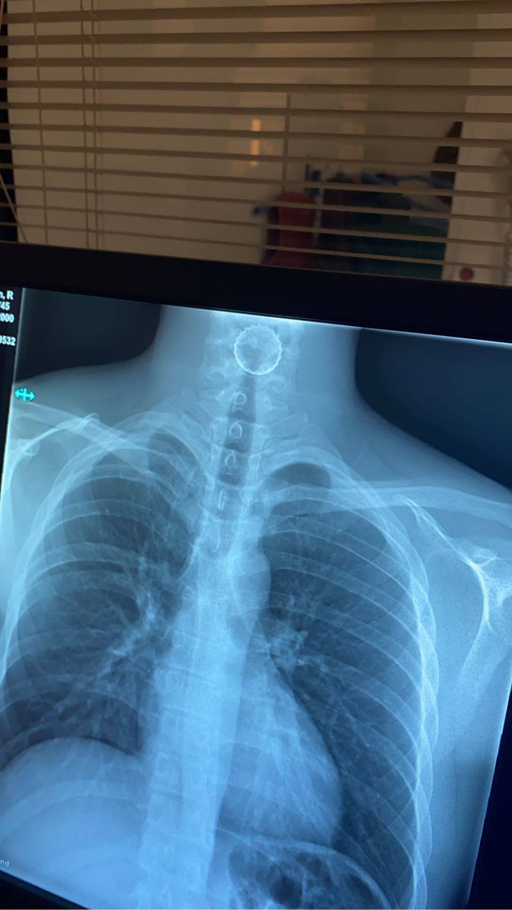 DUMPERT - Bierdopje ingeslikt