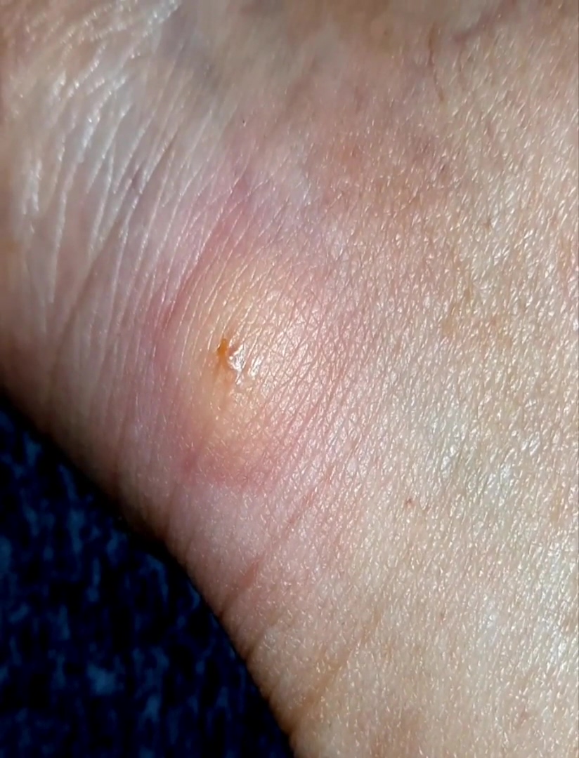 DUMPERT - Pulserende spinnenbeet