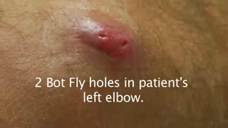 DUMPERT - Human Bot Fly